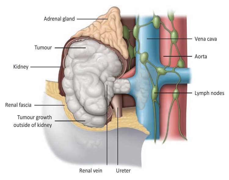 Kidney Cancer — Urology Care Toowoomba | Dr Nikhil Sapre Urologist