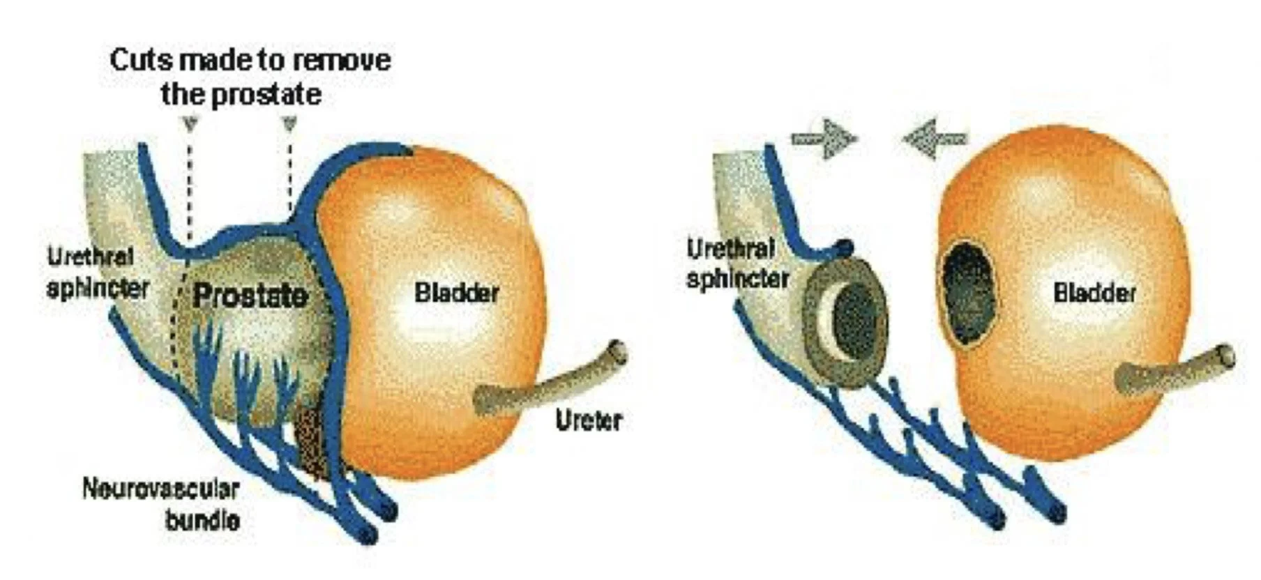 Prostatectomy Open Radical Urology Care Toowoomba Dr Nikhil Sapre Prostatectomy Open Radical Urology Care Toowoomba Dr Nikhil Sapre