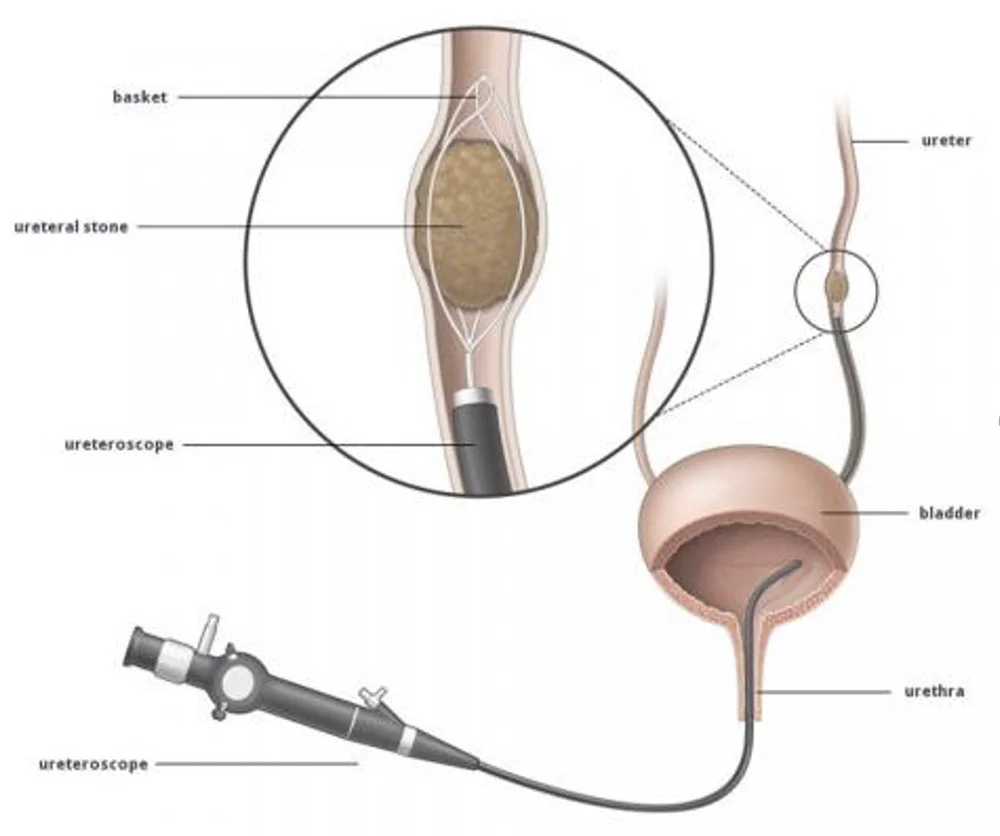 Ureteroscopy — Urology Care Toowoomba | Dr Nikhil Sapre Urologist