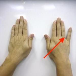 The 6 Features of Cubital Tunnel Syndrome — ChiroUp