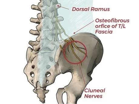 Maigne Syndrome: Sciatica of the Thoraco-Lumbar Junction — ChiroUp
