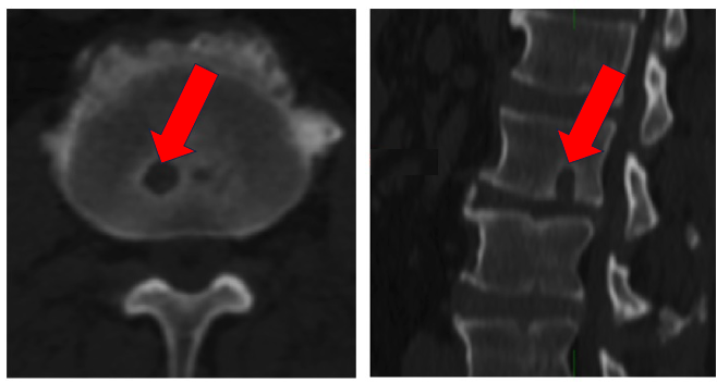 Schmorl’s Node Refresher: 7 Surprising Facts Every DC Must Own — ChiroUp