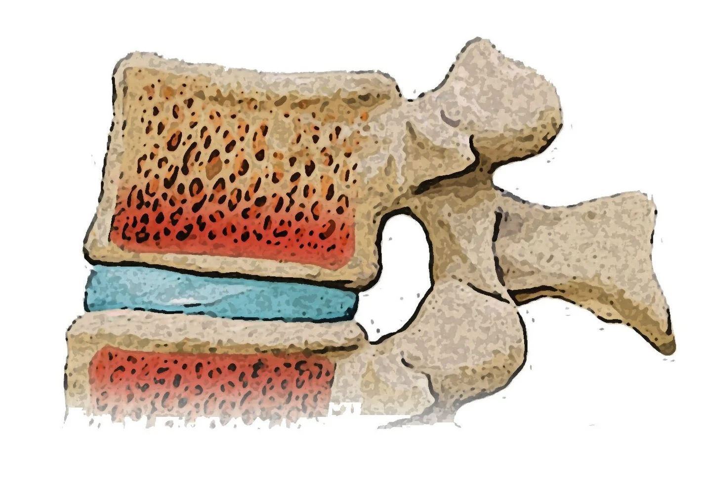 Demystifying Modic Changes - Your Ultimate 5-minute Guide — ChiroUp