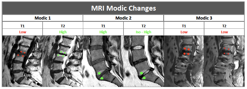 Demystifying Modic Changes - Your Ultimate 5-minute Guide — ChiroUp
