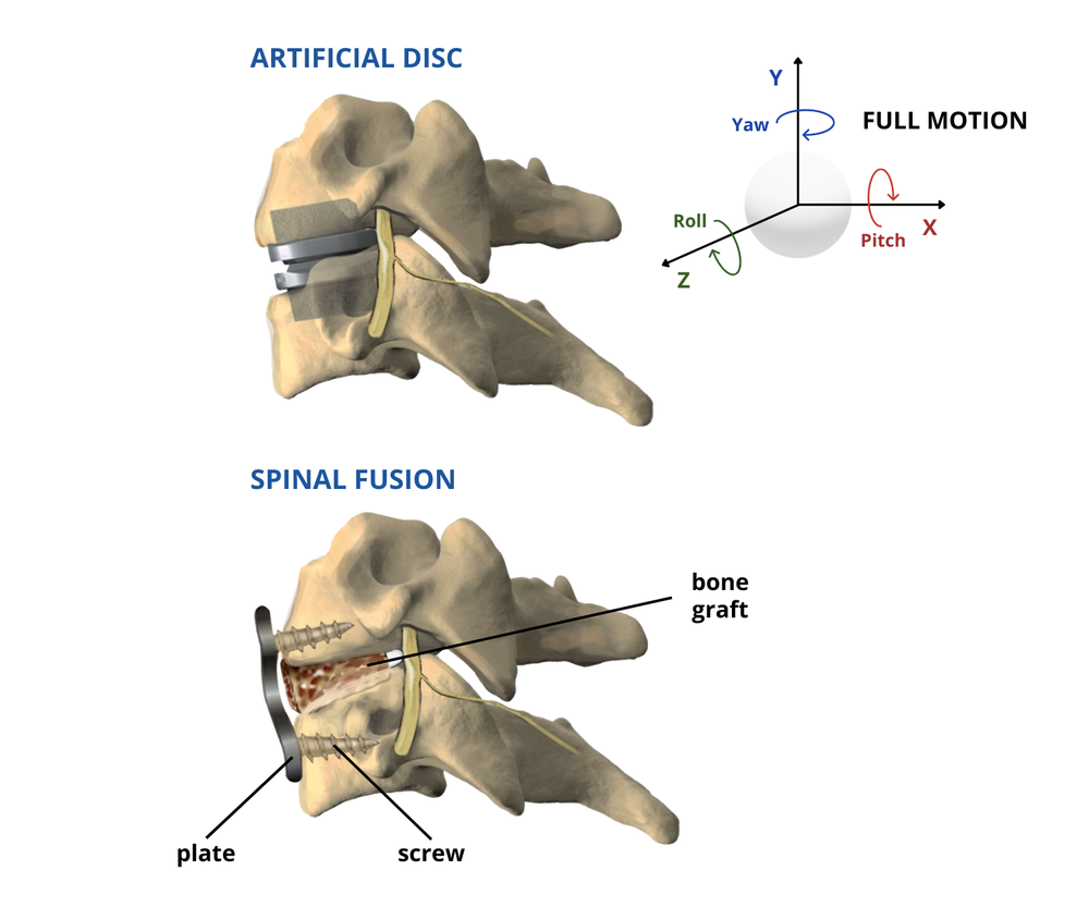 Cervical Disc Replacement: A Chiropractic Perspective — ChiroUp