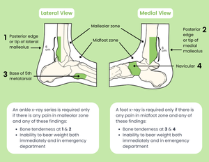The Ottawa Ankle Rules — ChiroUp