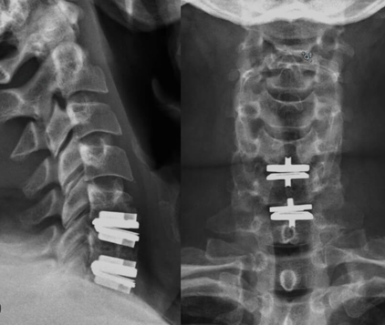 Cervical Disc Replacement: A Chiropractic Perspective — ChiroUp