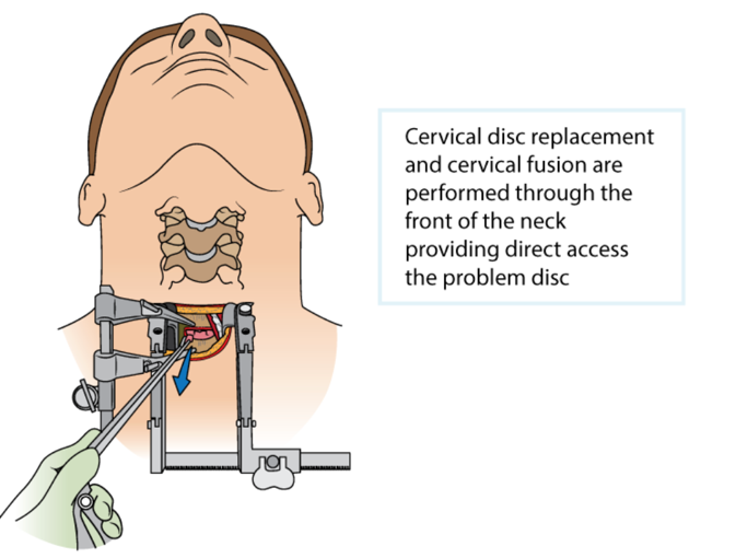 Cervical Disc Replacement: A Chiropractic Perspective — ChiroUp