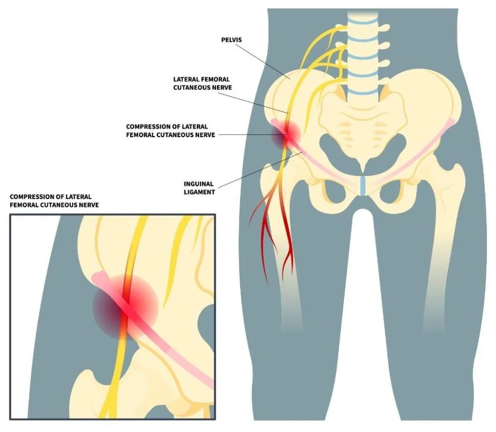 Meralgia Paresthetica: A Commonly Overlooked Cause of Thigh Pain — ChiroUp