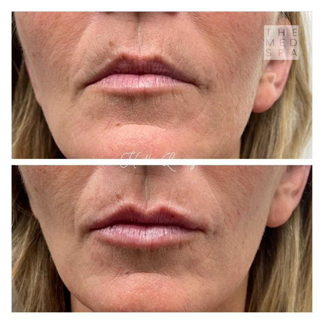 Before and Afters The Med Spa in Woodbury — Aesthetic Injectables | The ...