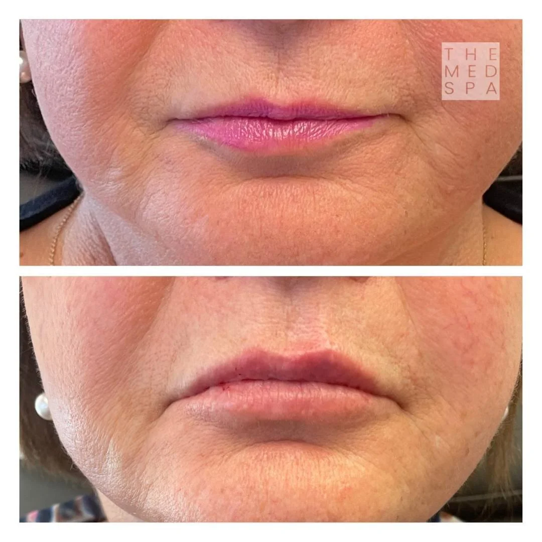 Before and Afters The Med Spa in Woodbury — Aesthetic Injectables | The ...