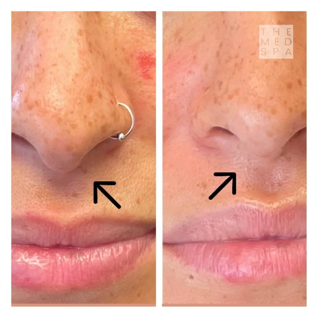 Before and Afters The Med Spa in Woodbury — Aesthetic Injectables | The ...