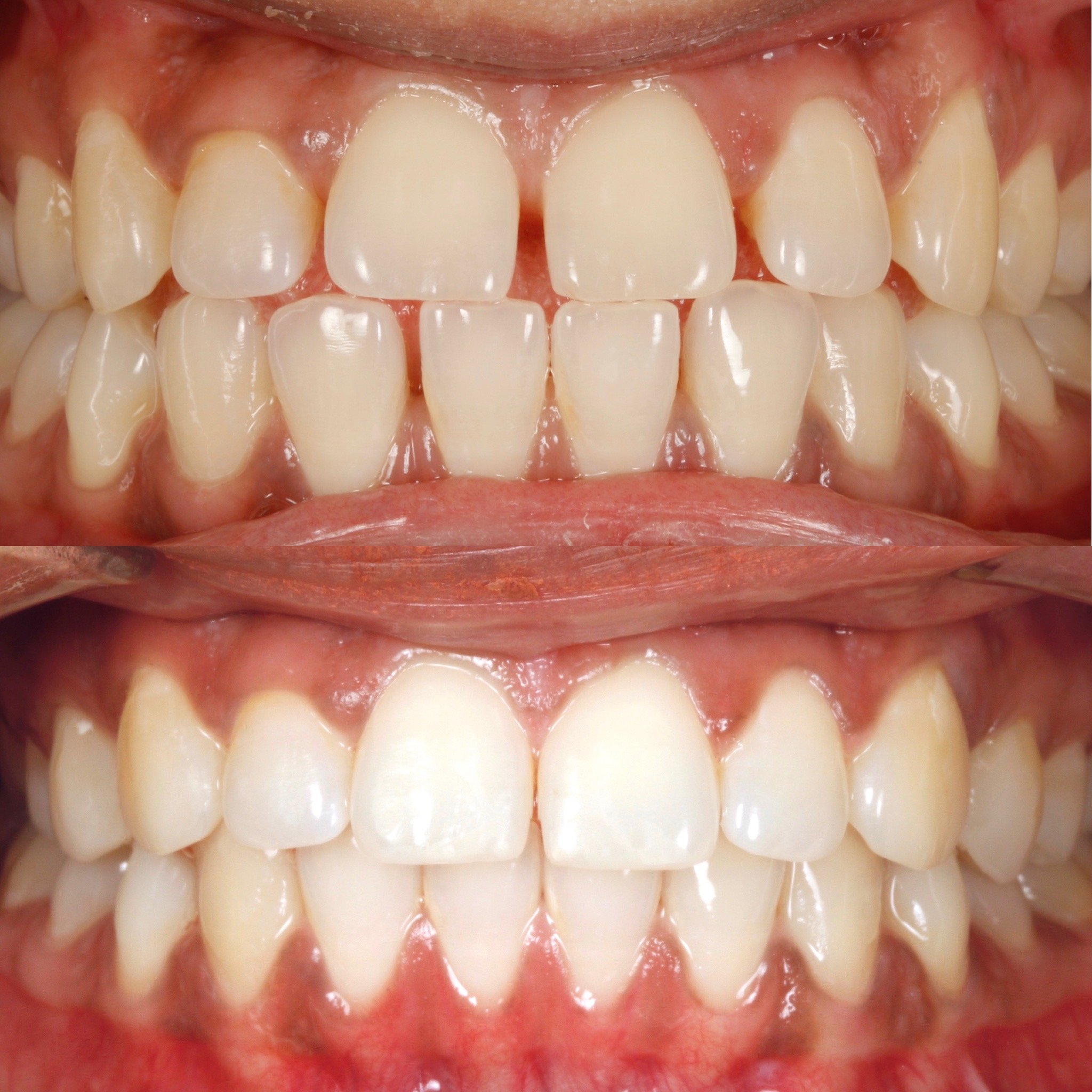 Before & After Photos of Invisalign in Sheffield — Invisalign ...