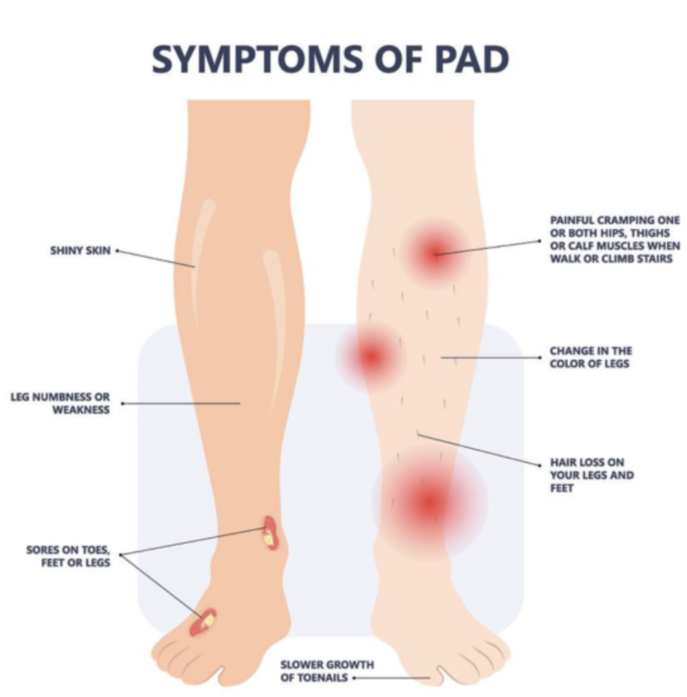 Blocked Leg Arteries | Florida Vascular Specialists