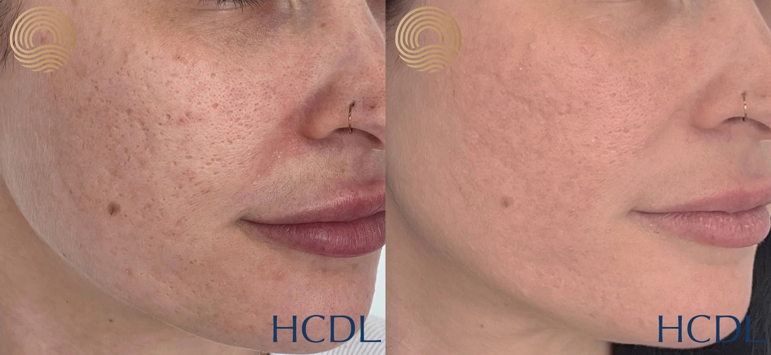 Acne Scarring Treatment | Best Results in Newcastle | Medical & Laser ...