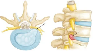 Physical Therapy for Cervical Disc Herniation - The Game Plan Physical ...