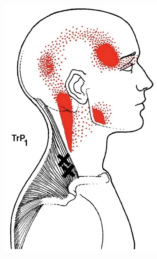 Cervicogenic Headache Exercises - The Game Plan Physical Therapy
