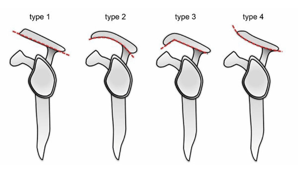 Shoulder Impingement Exercises - The Game Plan Physical Therapy