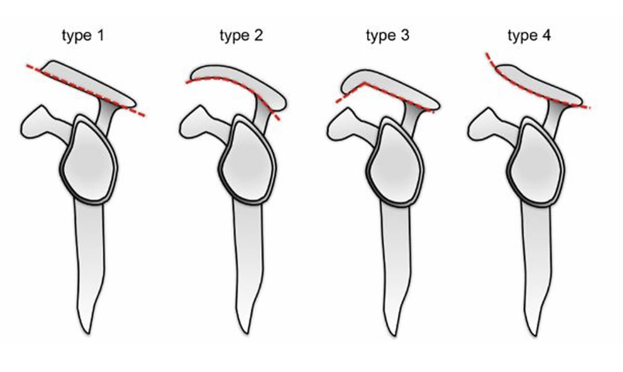 Shoulder Impingement Exercises - The Game Plan Physical Therapy