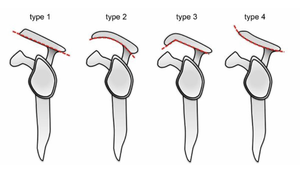 Shoulder Impingement Exercises - The Game Plan Physical Therapy