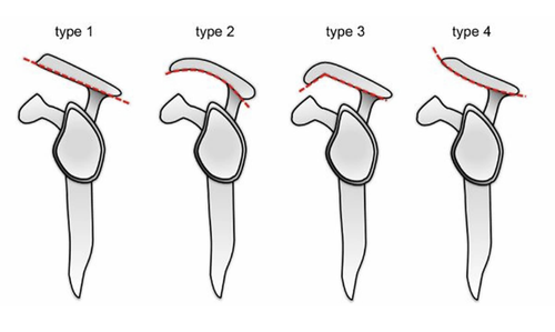 Shoulder Impingement Exercises - The Game Plan Physical Therapy