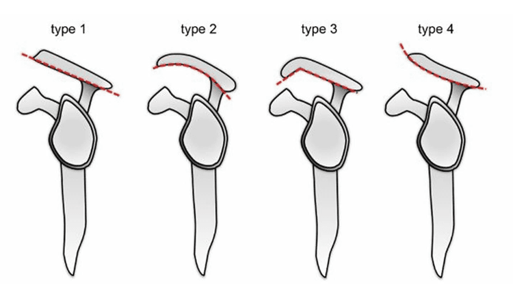Shoulder Impingement Exercises - The Game Plan Physical Therapy