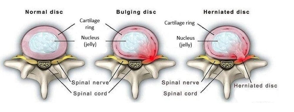 How Does Physical Therapy Help with Treating Lumbar Disc Herniations ...