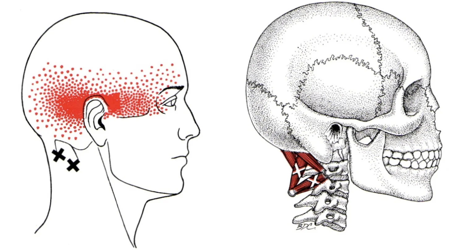 Cervicogenic Headache Exercises - The Game Plan Physical Therapy