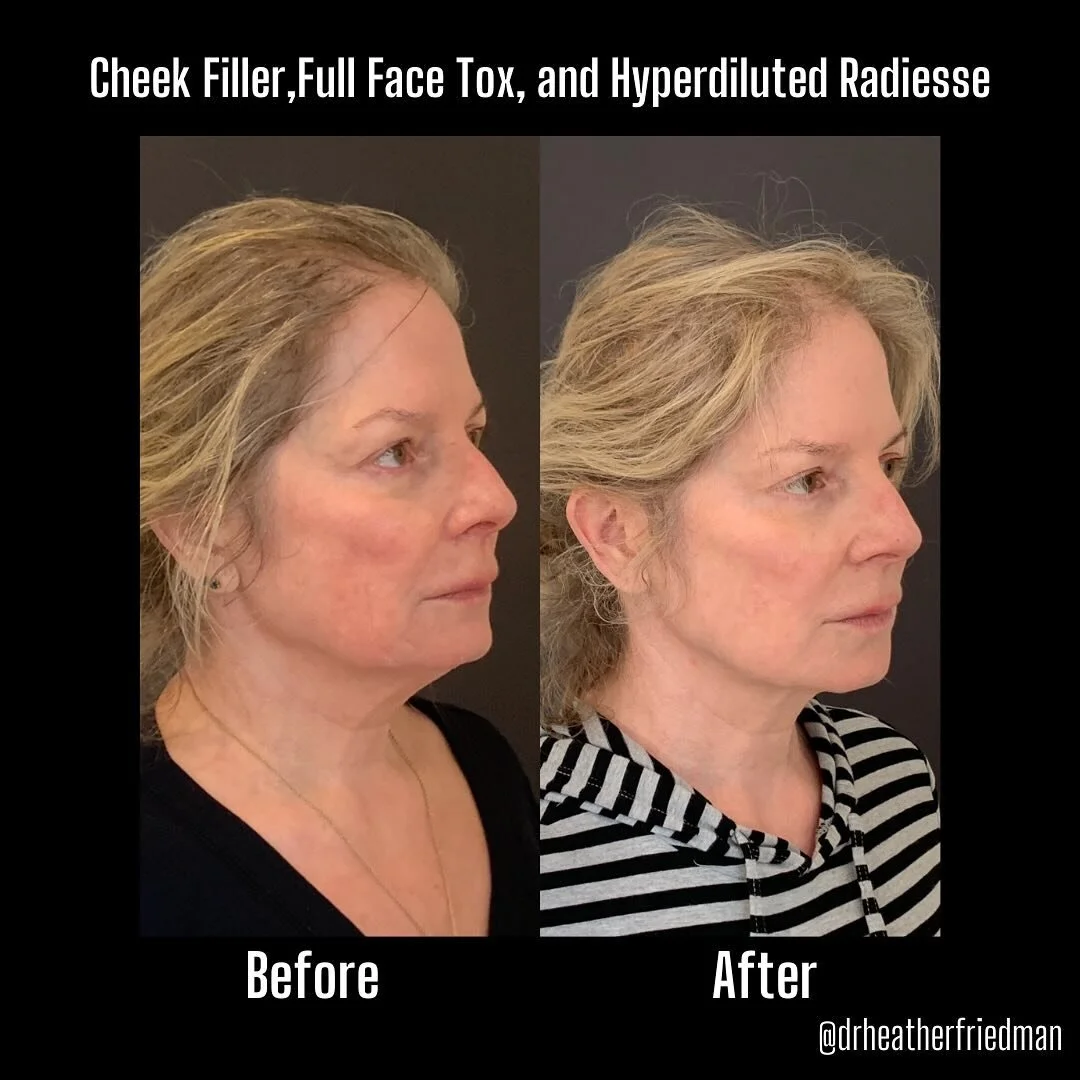 Botox for TMJ Portland | Masseter Botox Portland — Dr. Heather Friedman ...