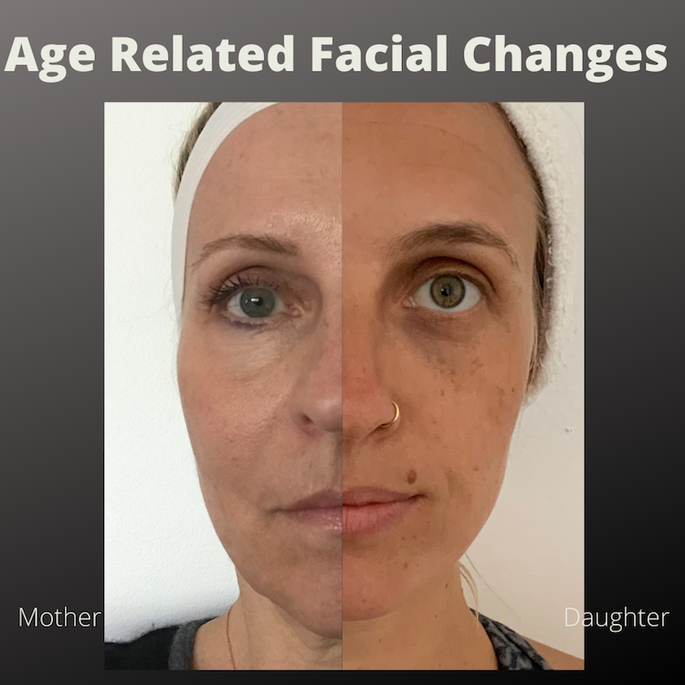 Age Related Facial Changes — Dr. Heather Friedman ND, LAc