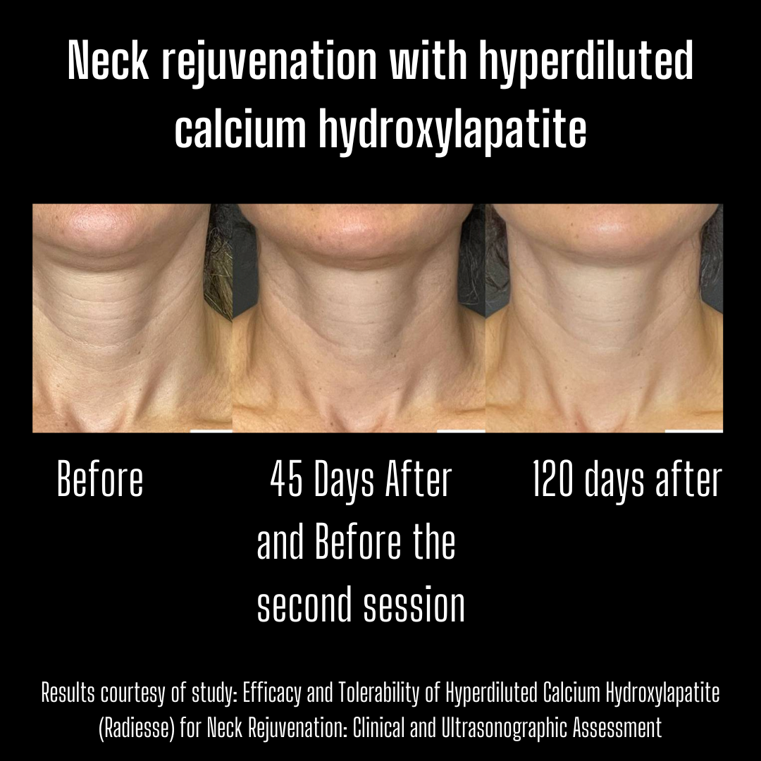 Injectable Fillers | Dr. Heather Friedman | Portland, OR — Dr. Heather ...
