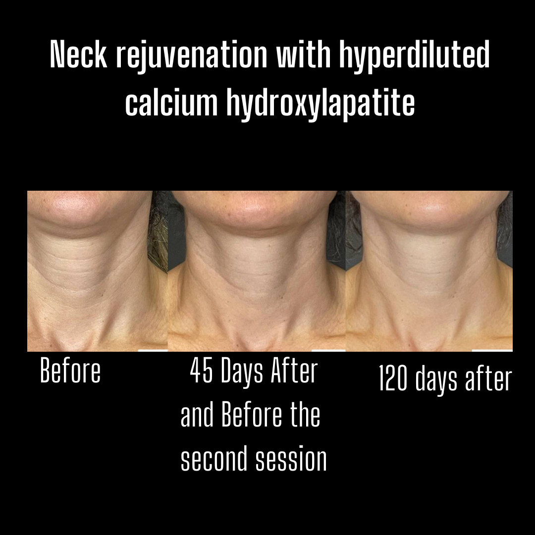Neck Rejuvenation with Hyper Diluted Radiesse in Portland, OR — Dr ...