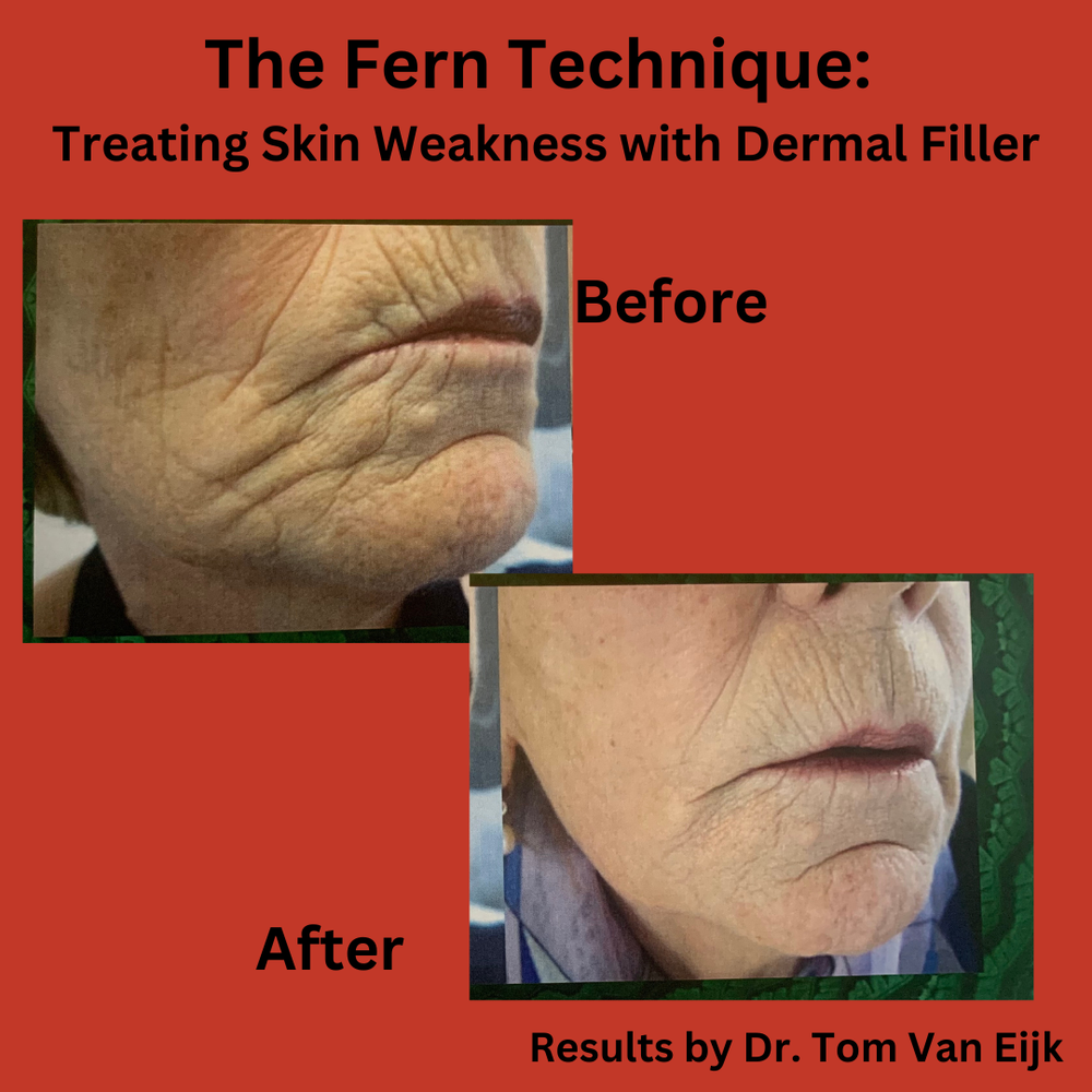 The Fern Technique — Dr. Heather Friedman ND, LAc