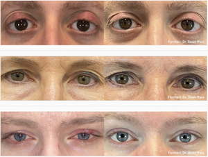 Forma-I: Transforming Dry Eye Treatment with Visual Proof (Before and ...