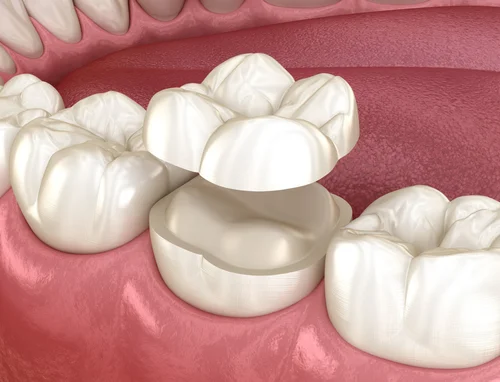 Why might you need a dental onlay? | My Ogden Dentist