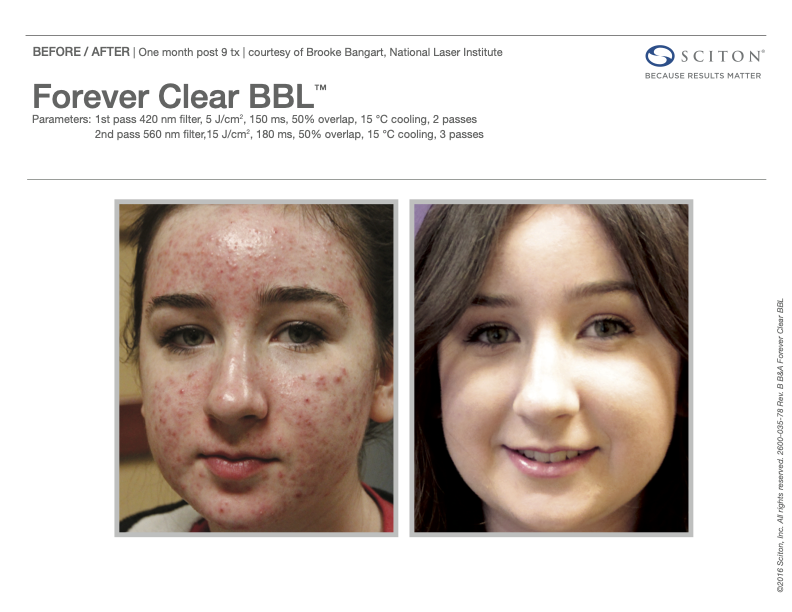 BBL Acne — Remedy Advanced Esthetics