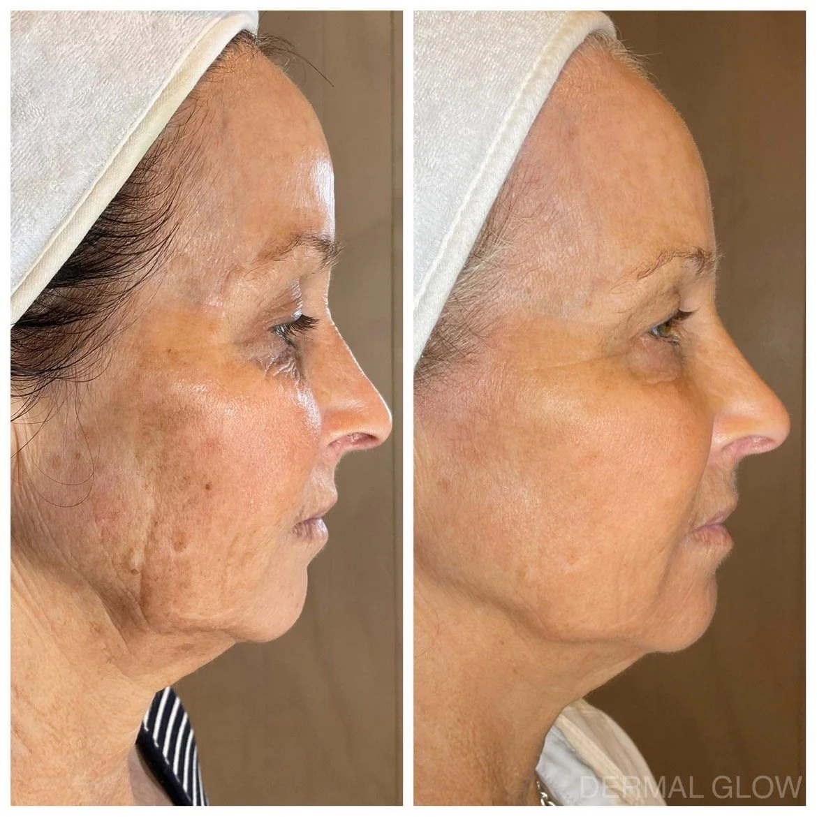 Moxi Laser Remedy Advanced Esthetics Moxi Laser Remedy Advanced Esthetics