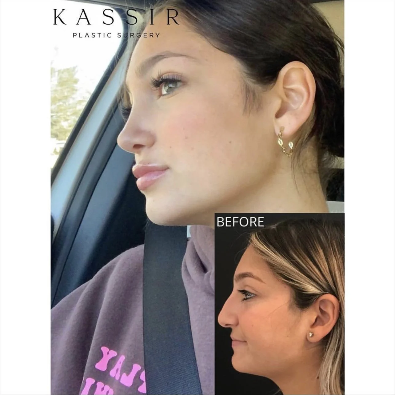 Best Rhinoplasty I Designer Rhinoplasty by Dr. Kassir — Kassir Plastic ...