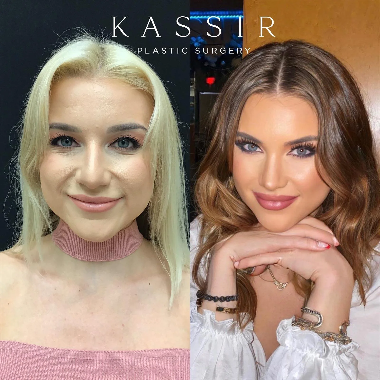 Best Rhinoplasty I Designer Rhinoplasty by Dr. Kassir — Kassir Plastic ...