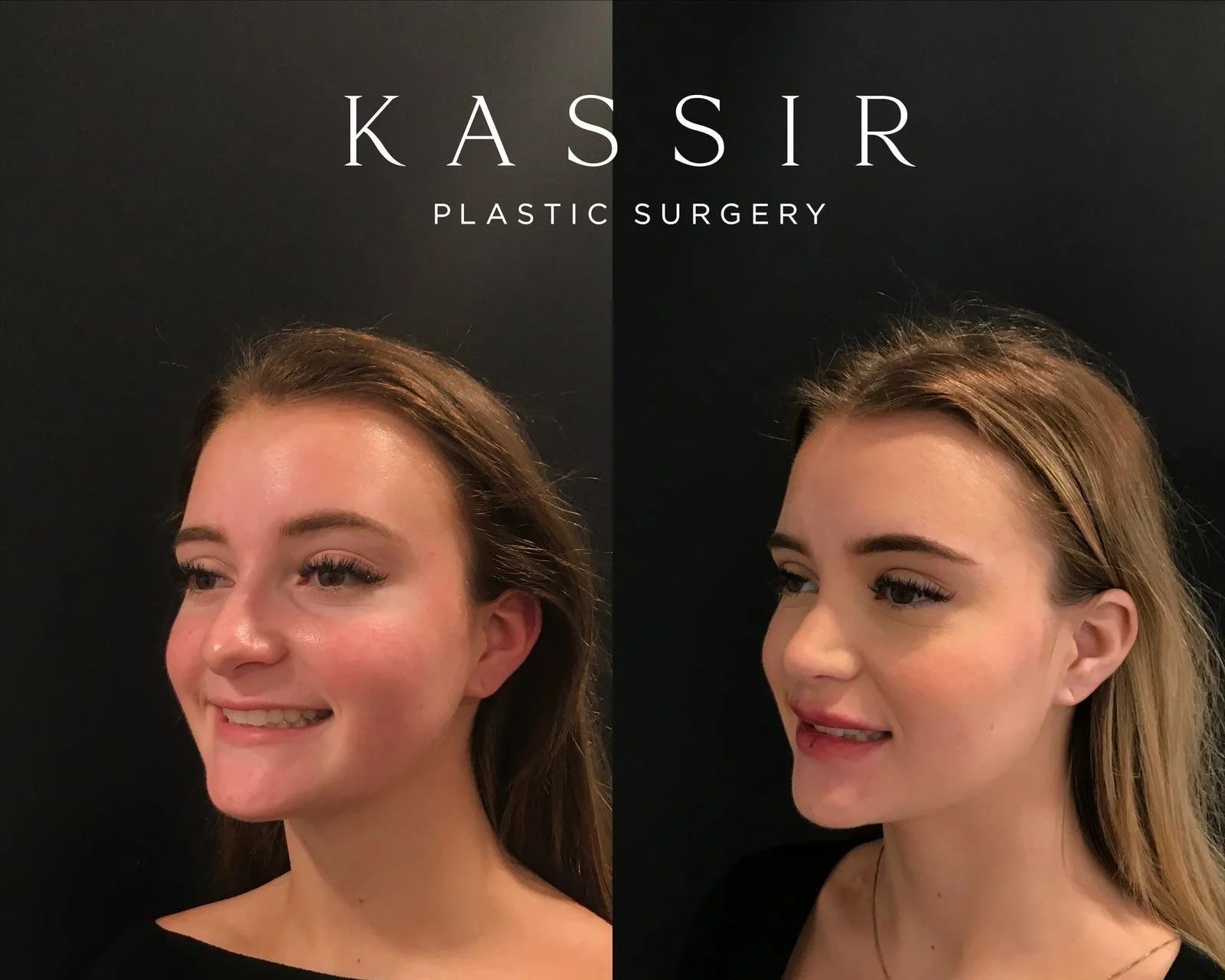 Dr Kassir Rhinoplasty Cost