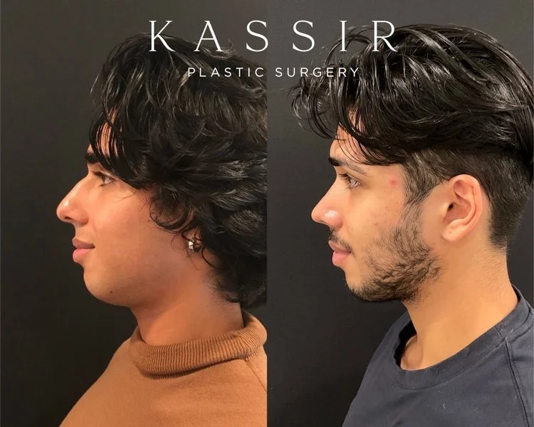 Best Rhinoplasty I Designer Rhinoplasty by Dr. Kassir — Kassir Plastic ...