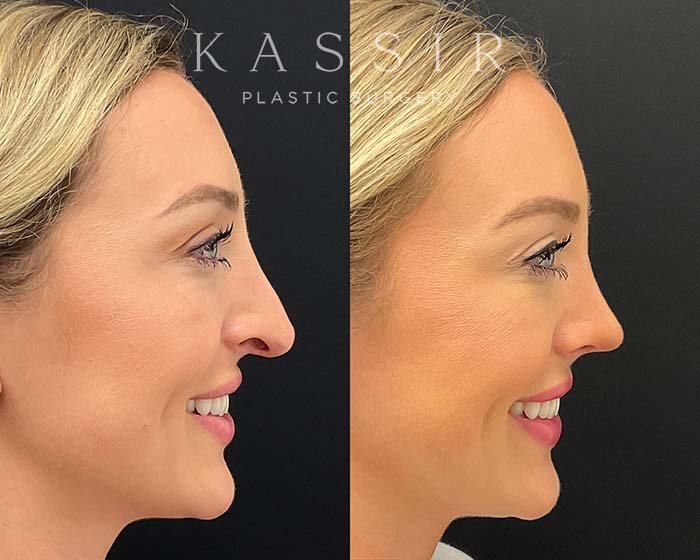 Celebrity Septoplasty Before And After