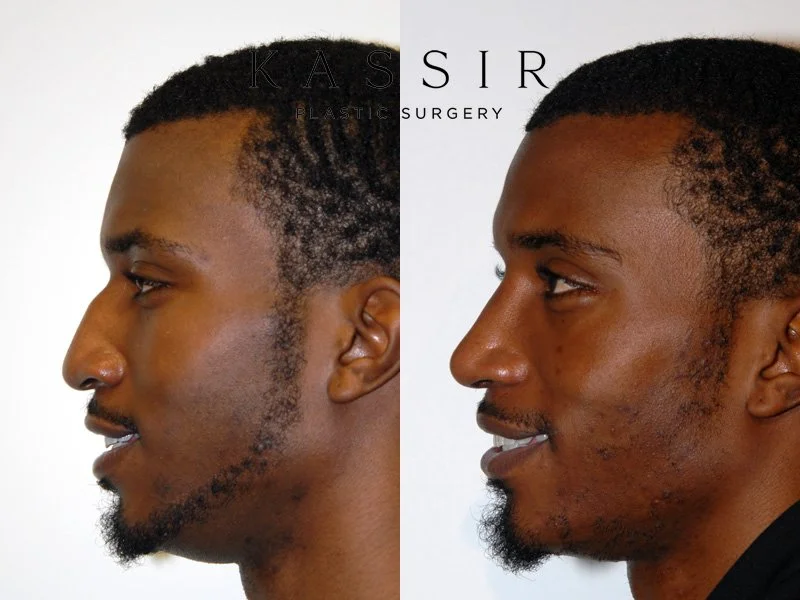 Ethnic Rhinoplasty / Black Male Rhinoplasty — Kassir Plastic Surgery in ...