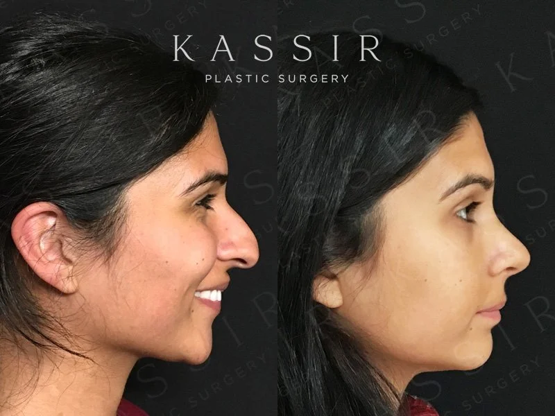 Ethnic Female Rhinoplasty / Indian Rhinoplasty — Kassir Plastic Surgery ...