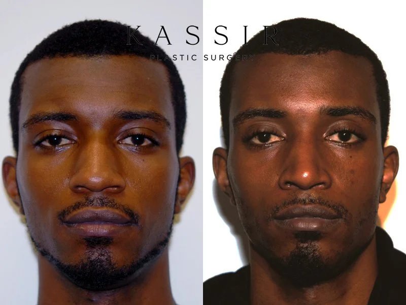 Black Person Nose Job