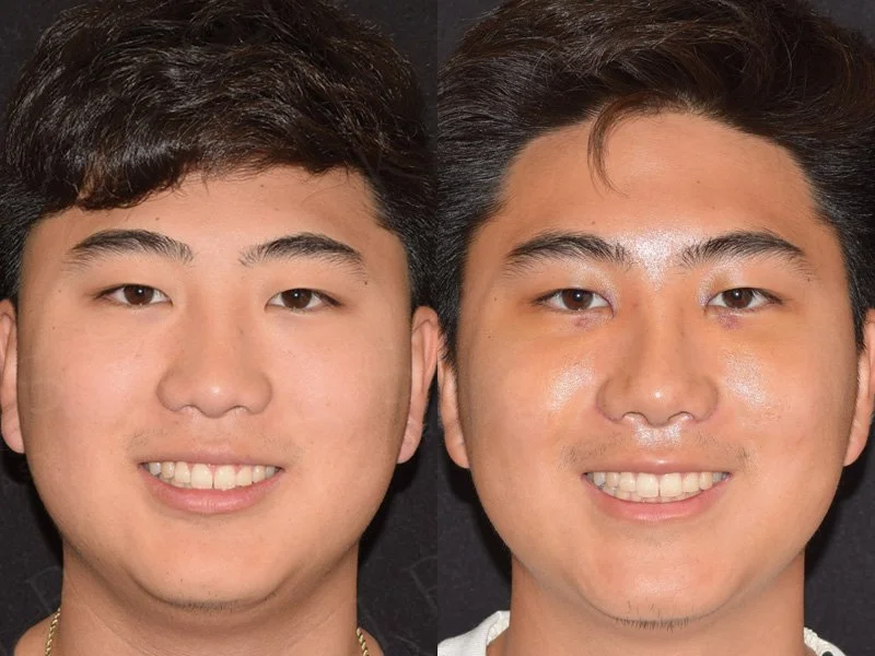 Ethnic Rhinoplasty / Asian Male Rhinoplasty Before and After — Kassir ...