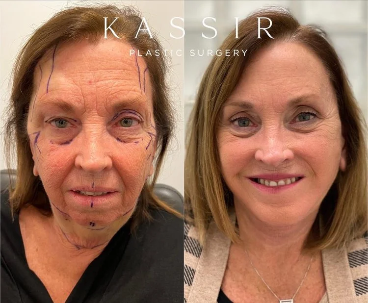 Before and After Facelifts. All healing stages and tips for a quick ...