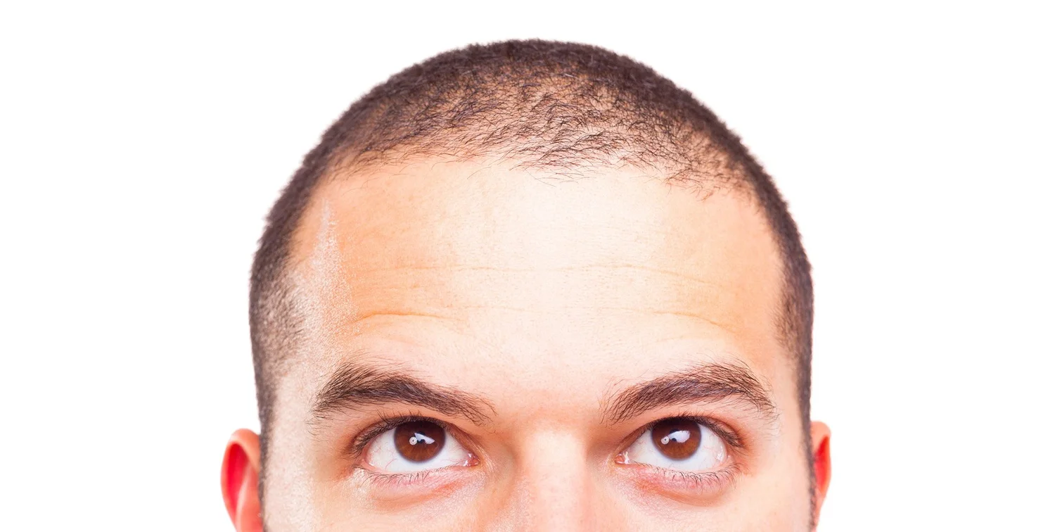 Cutis Verticis Gyrata Surgery — Kassir Plastic Surgery in NY and NJ