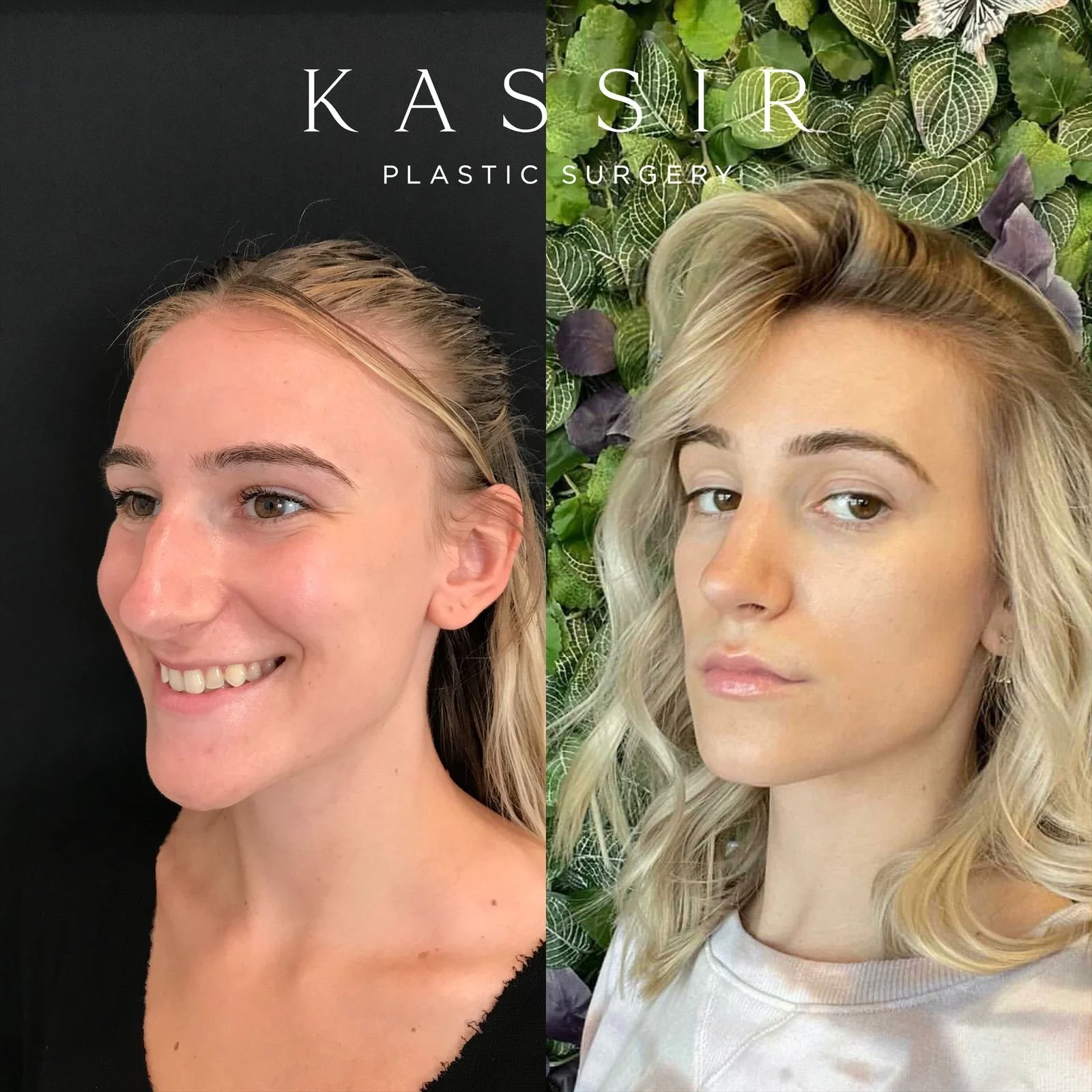 Best Rhinoplasty I Designer Rhinoplasty by Dr. Kassir — Kassir Plastic ...