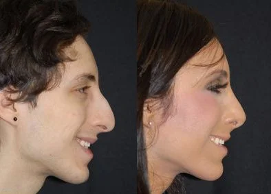 Transgender Rhinoplasty — Kassir Plastic Surgery in NY and NJ